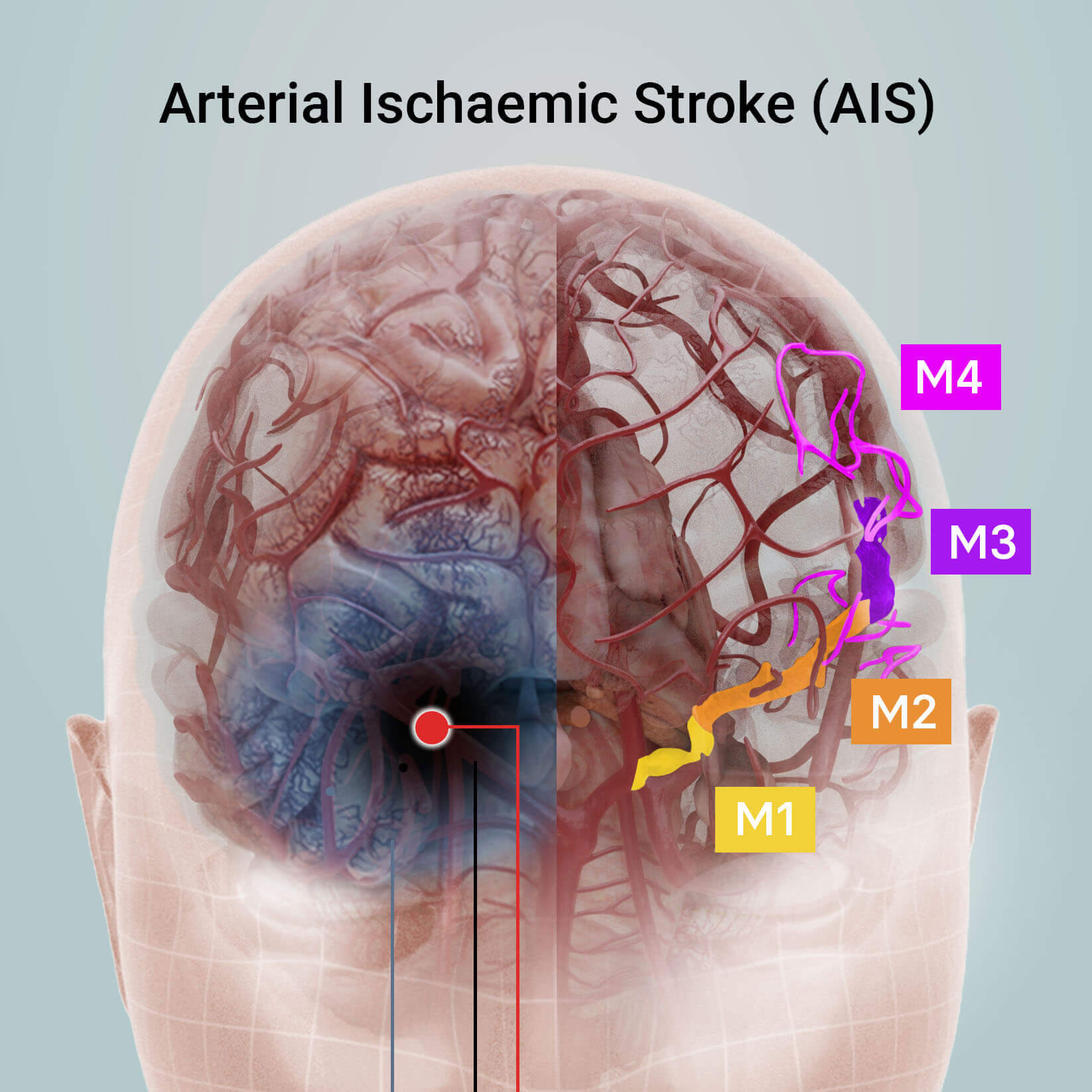 First stroke patient treated with afamelanotide - CLINUVEL