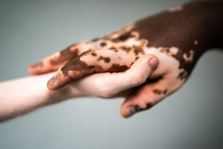 VIPOC launches Vitiligo Patient Views survey - CLINUVEL